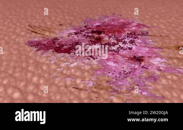 Inflammation of the skin Stock Videos & Footage - HD and 4K Video Clips ...