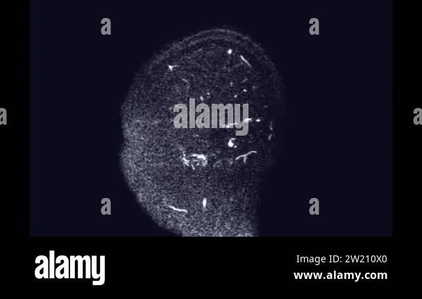 MRV Brain or magnetic resonance venography of The Brain sagittal 3D ...