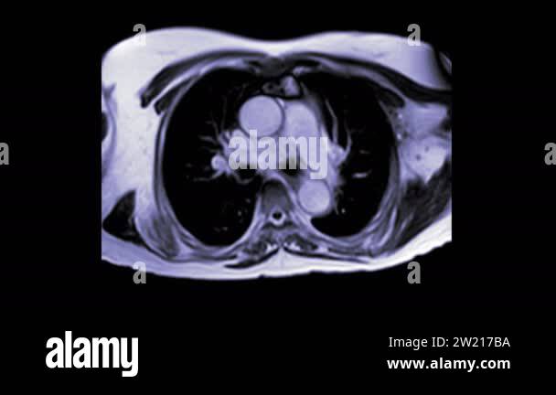 MRI heart or Cardiac MRI magnetic resonance imaging of heart in 3 ...