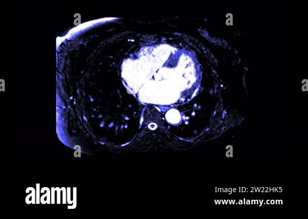 MRI heart or Cardiac MRI magnetic resonance imaging of heart in 3 ...