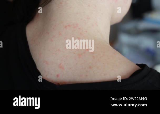 red pimples on the skin on the girls neck. Irritation and allergy ...