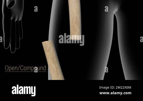 Fractures fractures Stock Videos & Footage - HD and 4K Video Clips - Alamy