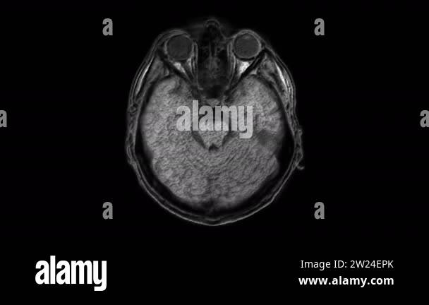 Voluminous MRI scans of the brain and head to detect tumors. Diagnostic ...