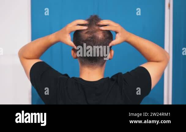 A young man with a bald head at a trichologist's appointment in the ...