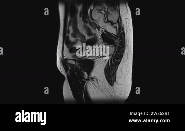 MRI of the female pelvic organs, abdominal cavity, gastrointestinal ...