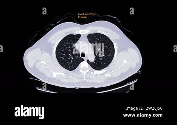 CT Chest or HRCT Axial View with high resolution Lung filter technique for diagnosis TB ...