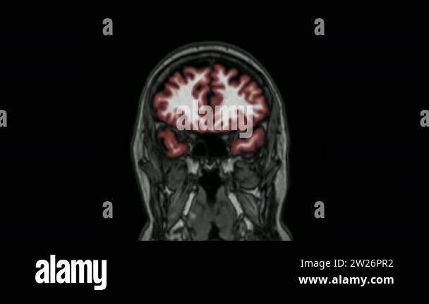 Magnetic resonance imaging of the brain in coronal plane color coded ...