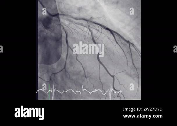 Coronary angiography is a test used to find out how much narrowing ...