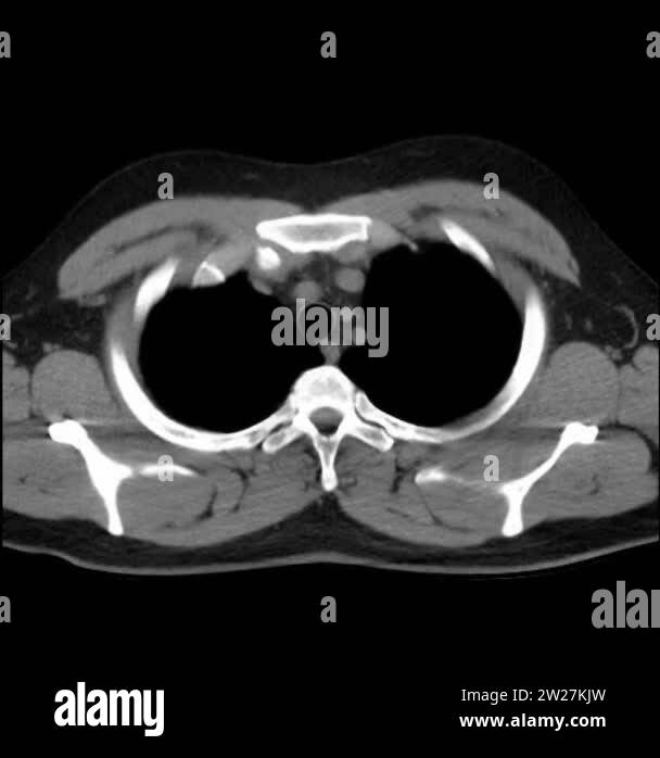 Computed tomography scan chest Stock Videos & Footage - HD and 4K Video ...