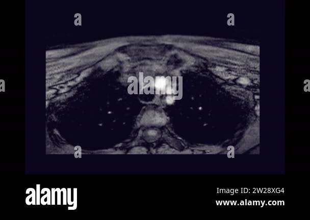 Carotid angiography Stock Videos & Footage - HD and 4K Video Clips - Alamy