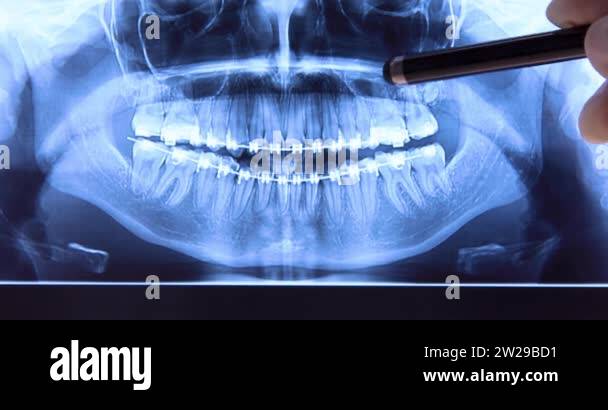Stomatologist analyzing dental x-ray with braces. Radiography for teeth ...