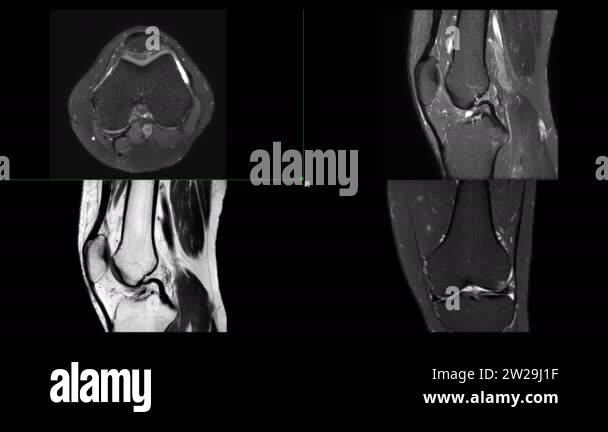 Compare of MRI knee or Magnetic resonance imaging of knee joint stir ...