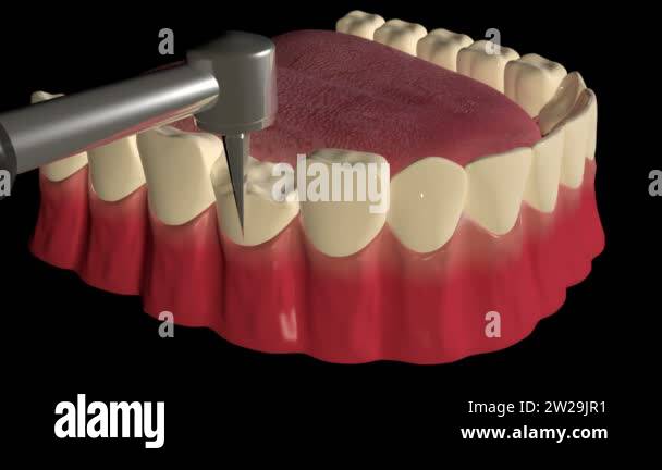 This video shows the procedure for applying a dental crown to protect a ...