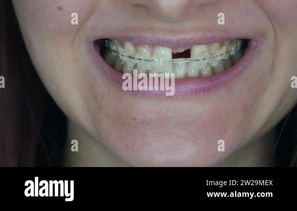 A woman's smile. Smile without upper left unit teeth. Tooth model with ...