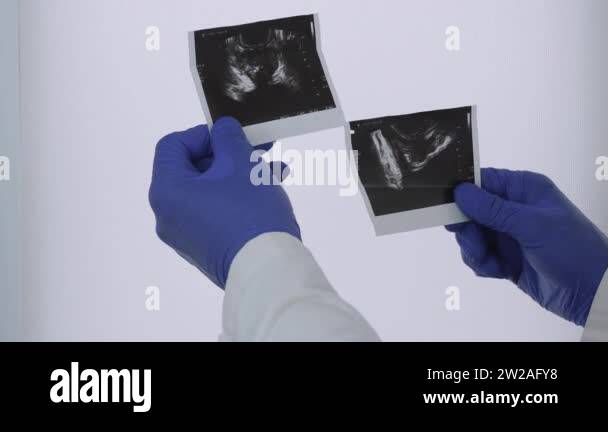 Prostate bph benign prostatic hyperplasia Stock Videos & Footage - HD ...