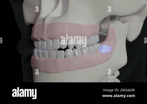 Wisdom tooth Stock Videos & Footage - HD and 4K Video Clips - Alamy