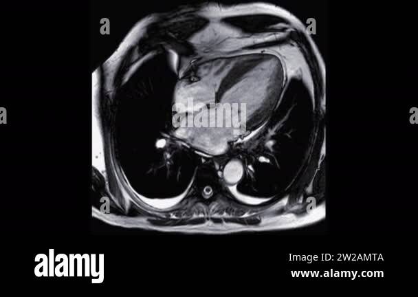 MRI heart or Cardiac MRI magnetic resonance imaging of heart in 4 ...