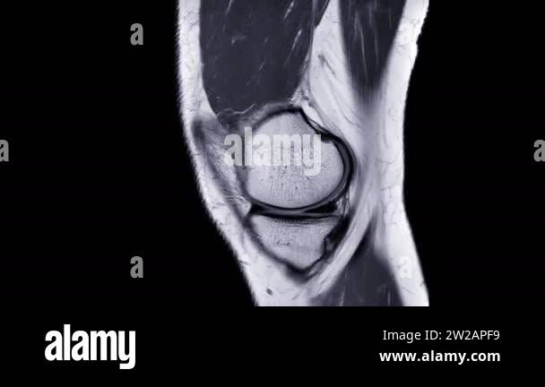 MRI knee or Magnetic resonance imaging of knee joint comparison ...