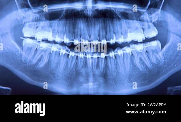 Dental x-ray with braces. Radiography for teeth straightening and ...