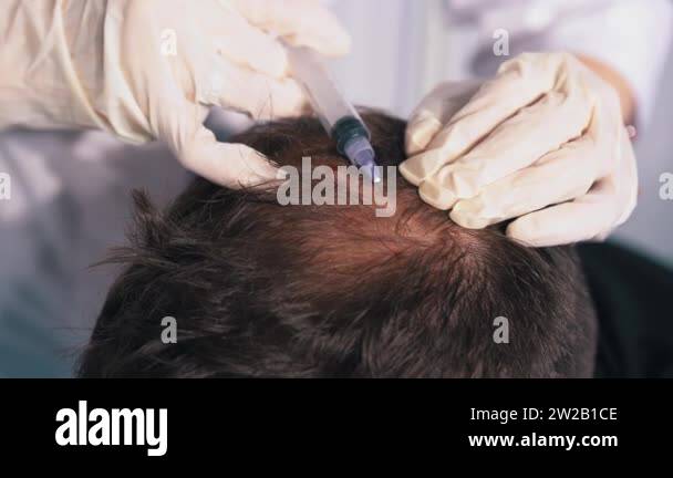 A young man on a hair restoration procedure against baldness ...
