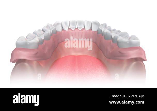 The lower false jaw rises above the gums showing a Ball attachment ...
