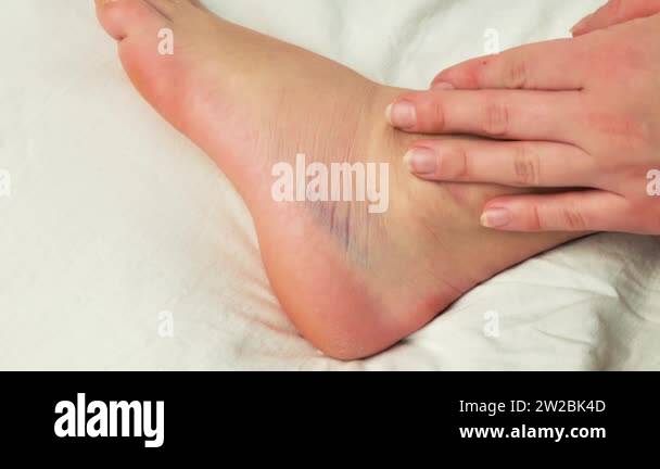 Woman is applying gel on her leg with sprained ankle with elastic ...