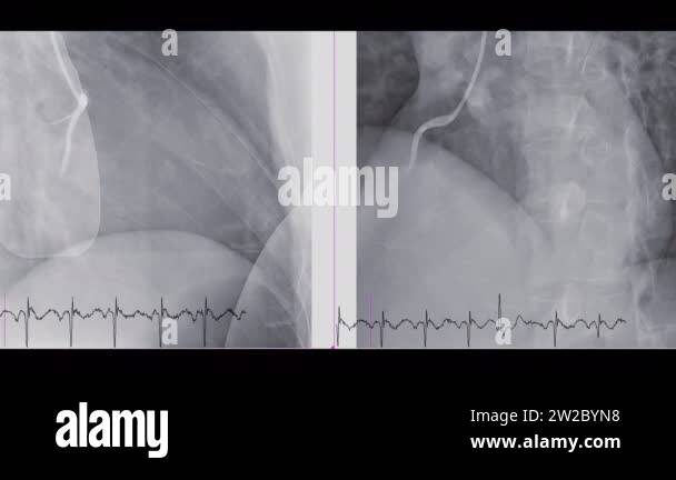 Coronary angiography is a test used to find out how much narrowing ...