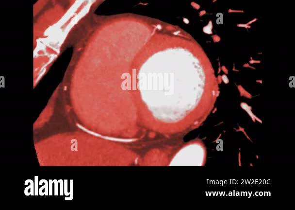 MRI heart or Cardiac MRI magnetic resonance imaging of heart in short ...