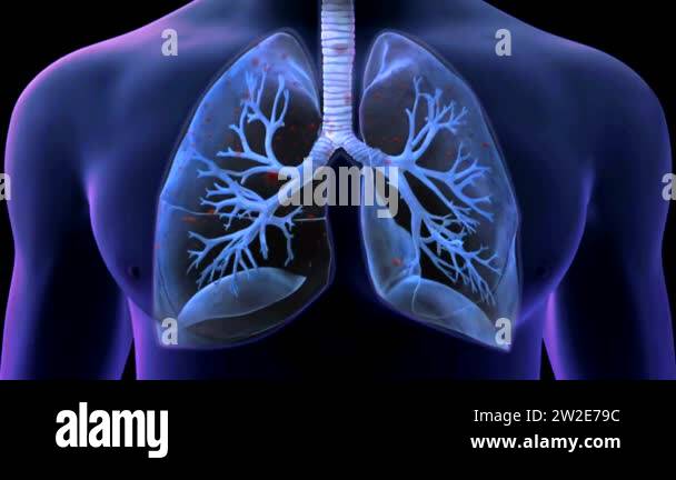 Lungs contagion. Realistic 3D footage animation of the severe acute ...
