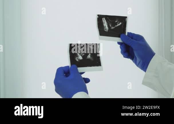 Picture of a man's prostate. An ultrasound scan of the prostate, in the ...