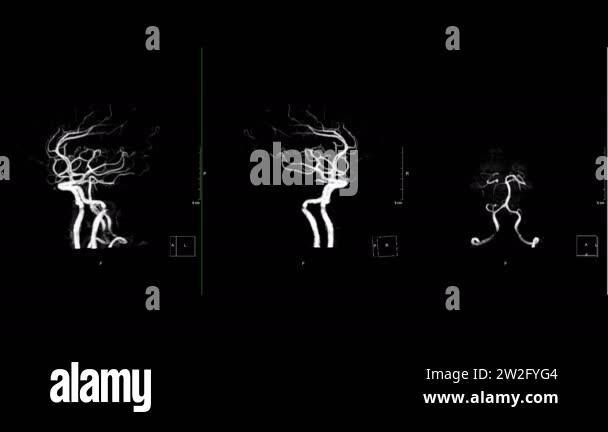 Collection of MRA Brain showing Cerebral artery in the brain turn ...