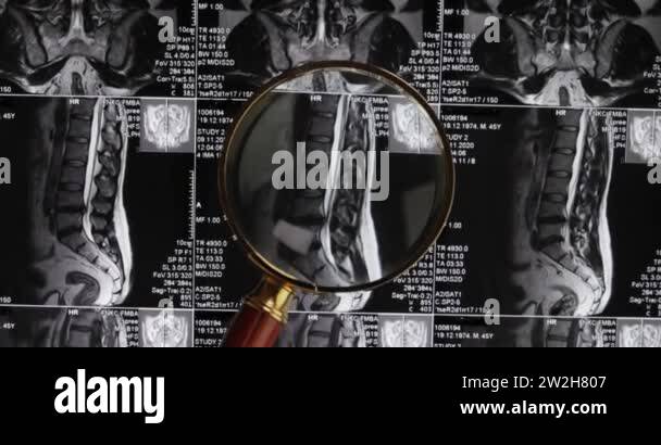 Mri Lumbar Spine Background Magnetic Resonance Tomography Doctor Examines Mri Of Lumbar Spine
