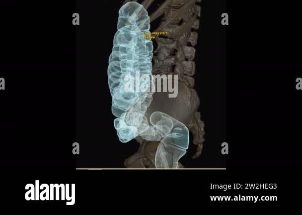 Bone cancer scan Stock Videos & Footage - HD and 4K Video Clips - Alamy