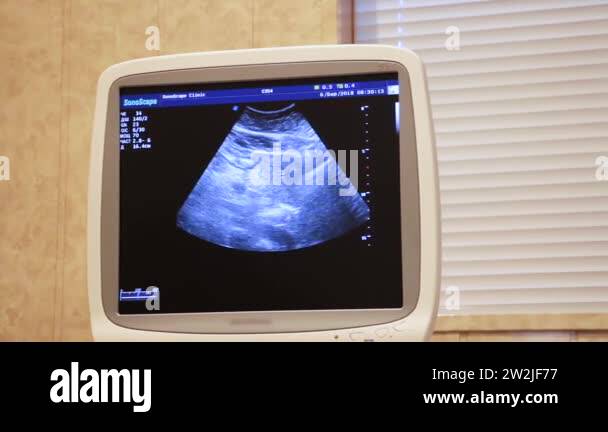 A monitor of a working, modern ultrasound machine is shown on which a ...