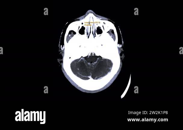 CTA Brain or computed tomography angiography of the brain axial mip ...