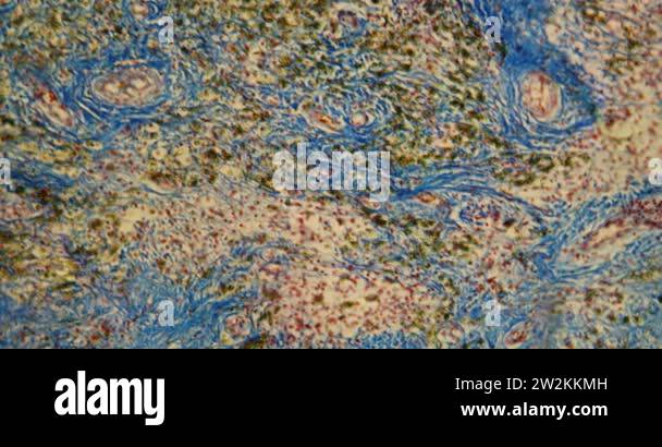 Foreign body granuloma with giant cells and hemosiderosis under the microscope 100x Stock Video ...