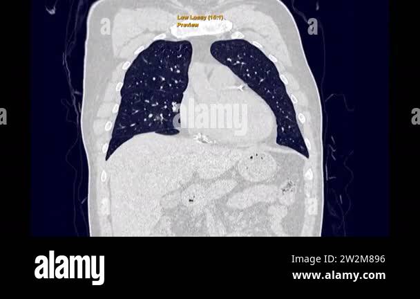 CT Chest or HRCT Coronal View with high resolution Lung filter ...