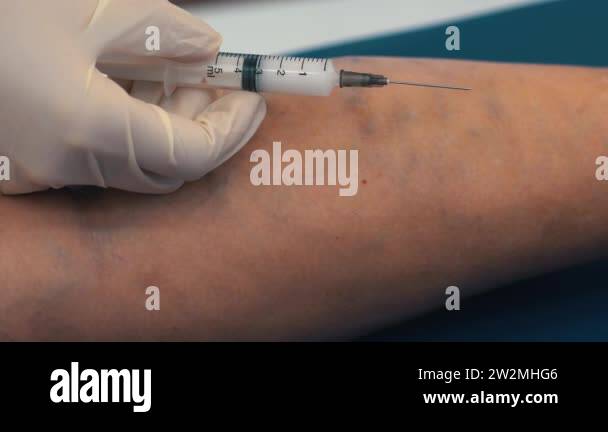 Varicose vein injection Stock Videos & Footage - HD and 4K Video Clips ...