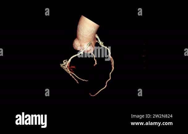 CTA Coronary artery 3D rendering image turn around on the screen for ...