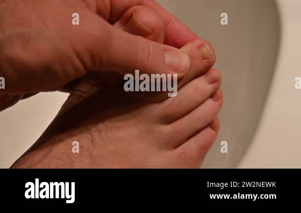 Close-up image of a fingernail on the right foot of a Caucasian man ...