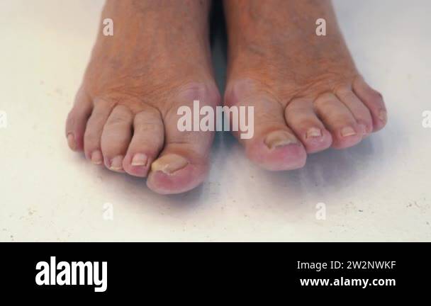 Female feet with fungus on the toes close-up. Toes with fungus. Old ...