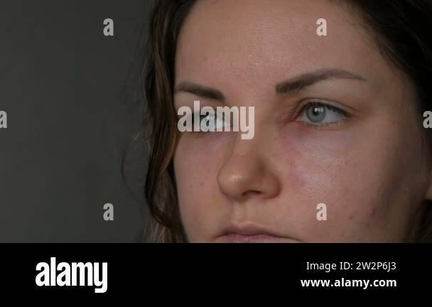 Young girl with an allergic reaction on the face and eyes, Quinckes ...