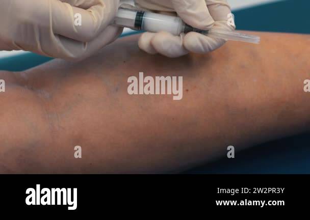 Treatment of varicose veins with injections. An injection into a vein ...