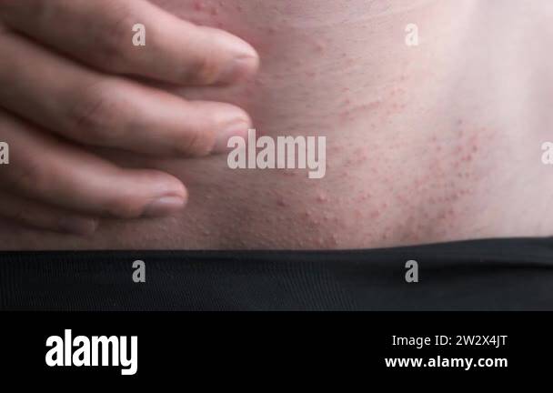 Spots on the abdomen Stock Videos & Footage - HD and 4K Video Clips - Alamy
