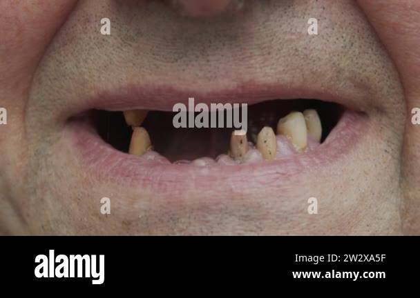 A man shows his rotten teeth. Periodontal disease. Sawn teeth before ...