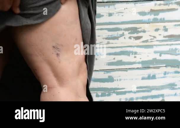 Bad leg and Illness of human skin. Swollen veins, cellulite and age ...