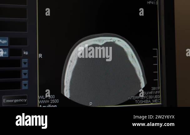 Time lapse of MRI brain scan, timelapse of monochrome magnetic ...
