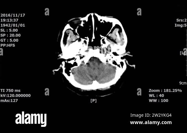 Computed tomography ct scan brain Stock Videos & Footage - HD and 4K ...