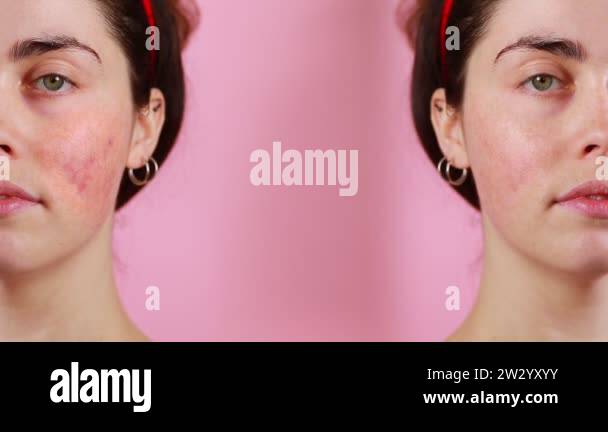 Two half of faces of a young caucasian woman in close-up showing the result before and after ...