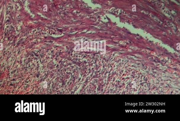 Tissue necrosis Stock Videos & Footage - HD and 4K Video Clips - Alamy